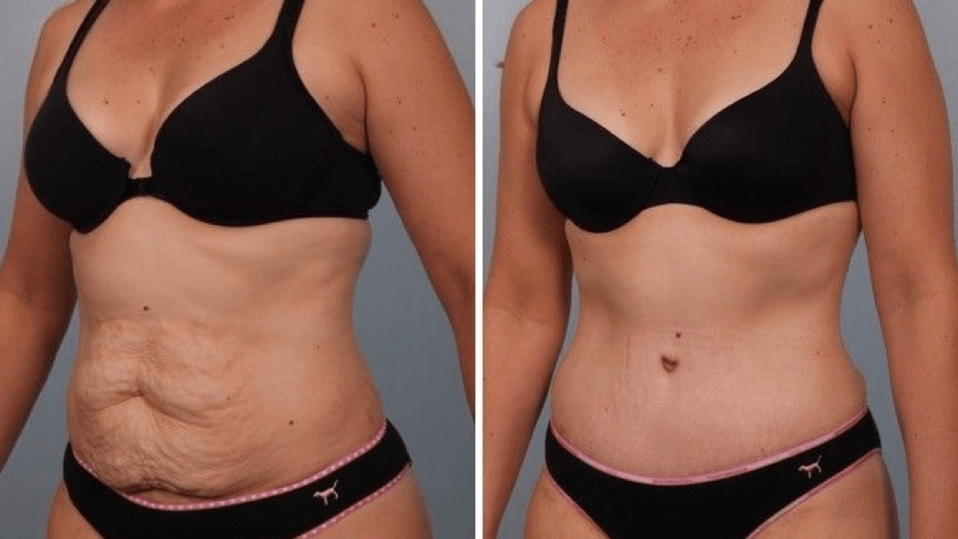 Tummy Tuck Dodream Plastic Surgery